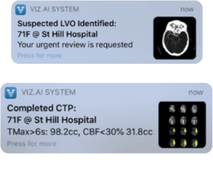 Viz™ Neuro | AI-Powered Neurovascular Care Coordination