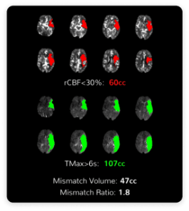 Viz™ CTP | AI-Powered Neurovascular Care Coordination
