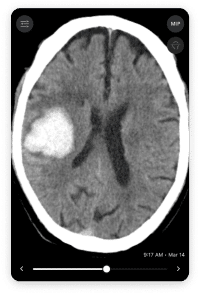 Intracerebral hemorrhage (ICH) detection | Viz.ai