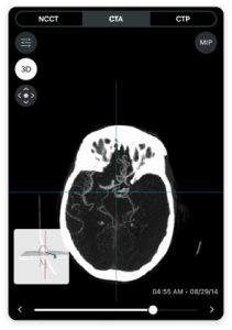 Viz™ LVO | AI-Powered Neurovascular Care Coordination