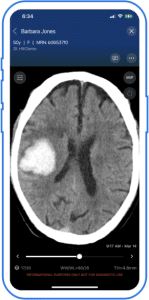 Viz™ Neuro | AI-Powered Neurovascular Care Coordination