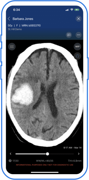 Viz™ Neuro | AI-Powered Neurovascular Care Coordination