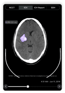 Viz™ Hemorrhage | AI-Powered Neurovascular Care Coordination